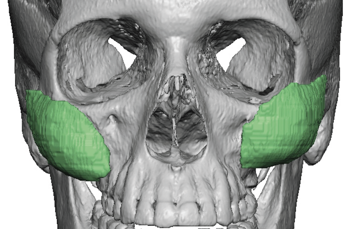 Plastic Surgery Case Study - Custom Cheek Implant Replacements for ...