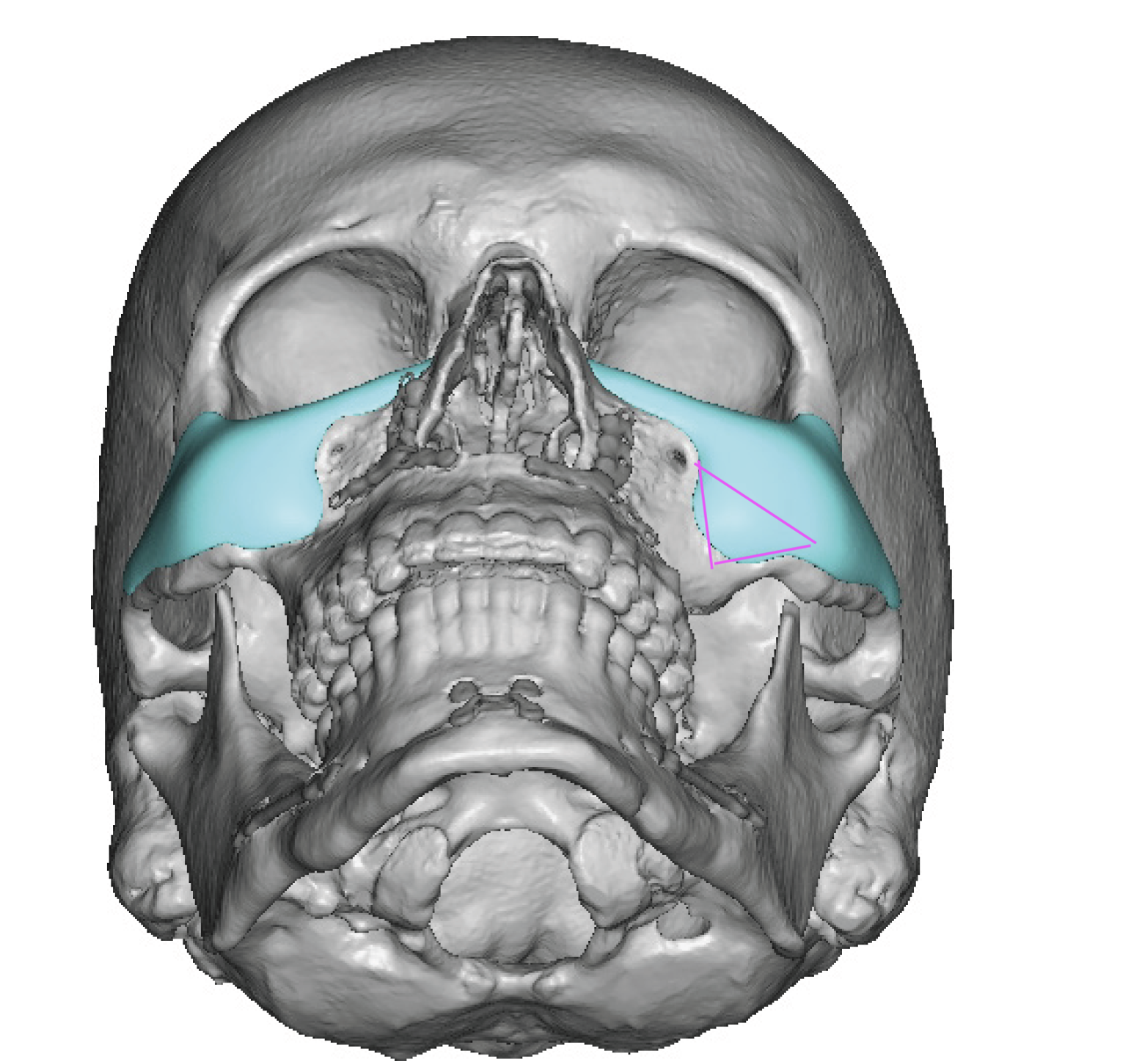 left ePTFE overlay implant placement 3D CT scan Dr Barry Eppley ...