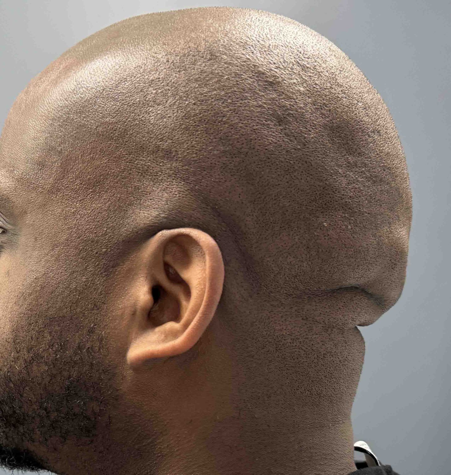 male back of head bone protrusion and scalp rolls side Dr Barry Eppley ...