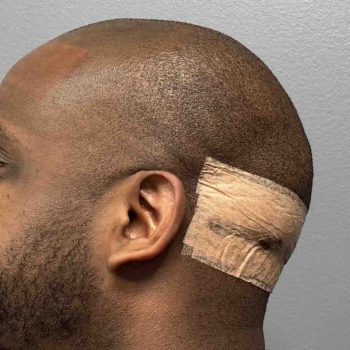 Plastic Surgery Case Study - Scalp Roll Excision with Nuchal Ridge ...