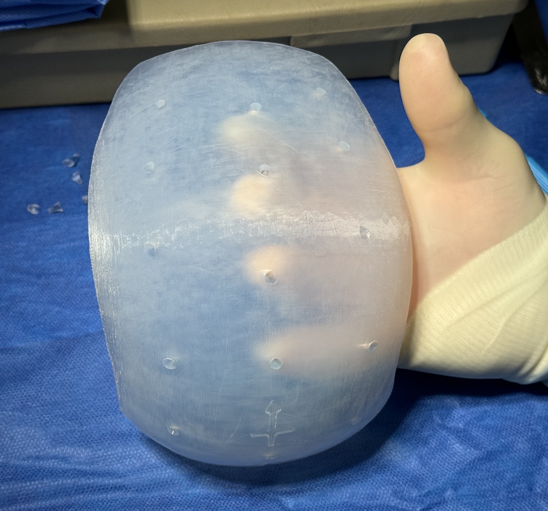 Plastic Surgery Case Study - Custom Skull Implant Correction of The ...