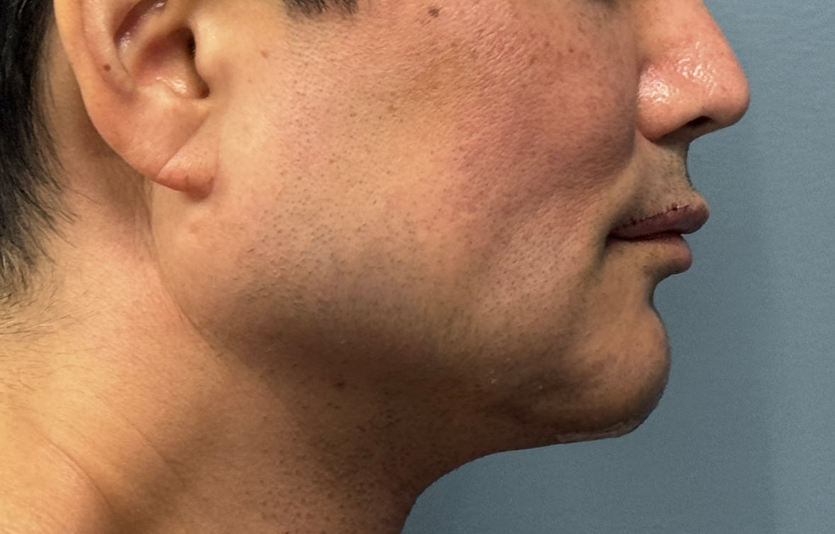 male customn jawline implan result side view Dder Barry Eppley ...