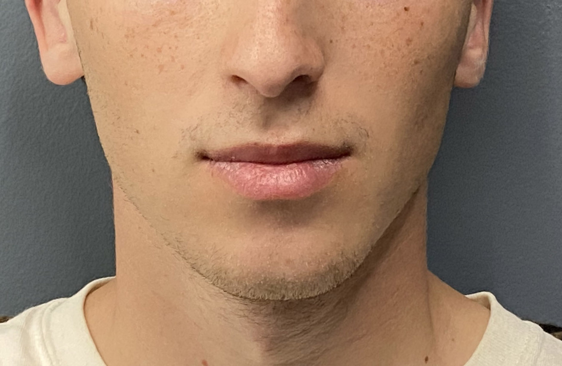 male face reshaping front 1 Dr Barry Eppley - Explore Plastic Surgery