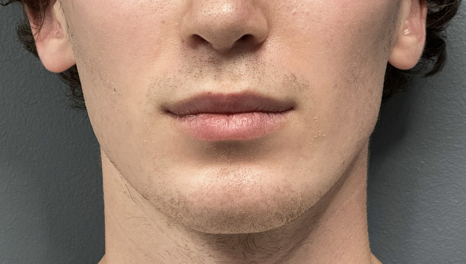 Plastic Surgery Case Study - Design, Placement and Long Term Outcome ...