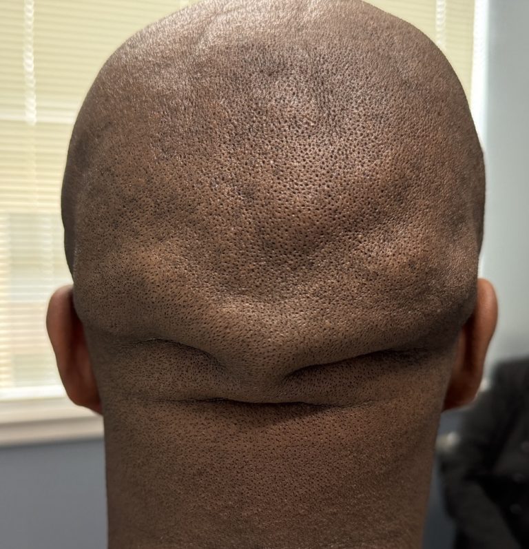 Plastic Surgery Case Study - Scalp Roll Excision with Nuchal Ridge ...