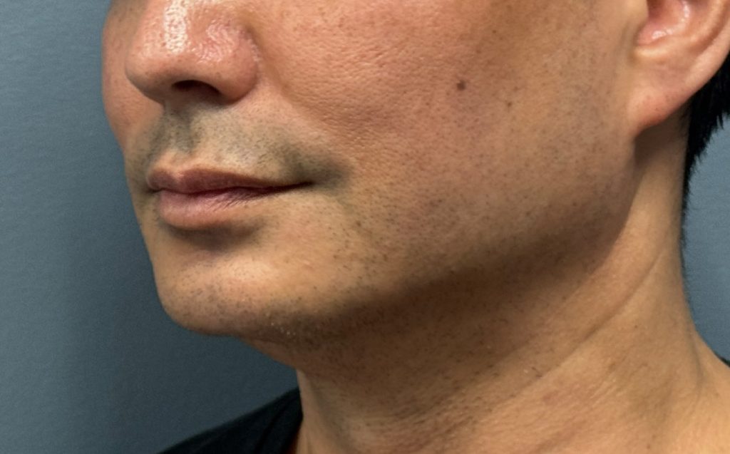 male vertcial jaw deficiency oblique view Dr Barry Eppley - Explore ...