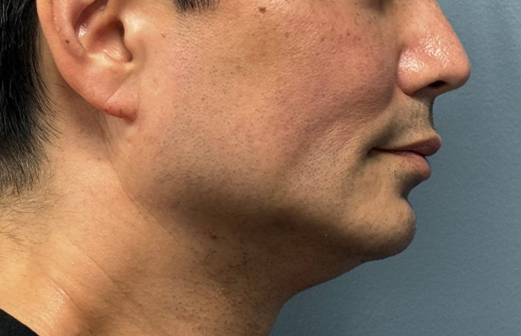 Plastic Surgery Case Study - Male Custom Jawline Implant To Favorably ...