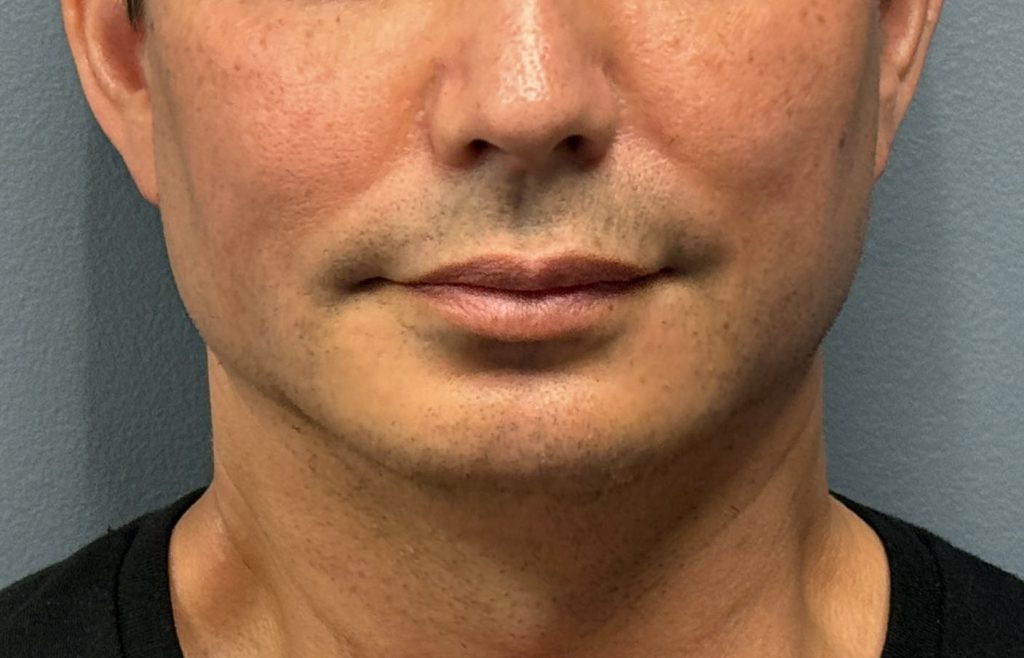Plastic Surgery Case Study - Male Custom Jawline Implant To Favorably ...
