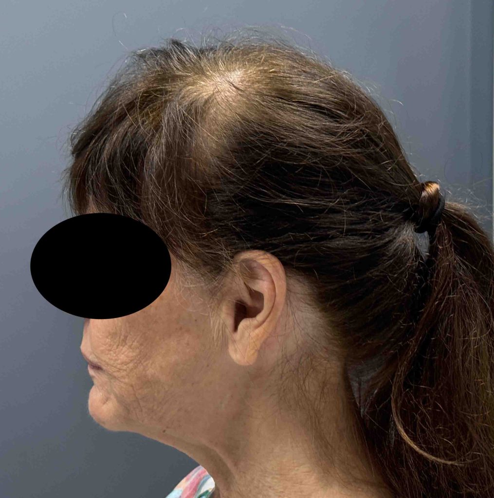 Plastic Surgery Case Study - 70 Year Old Female for Custom Crown of the ...