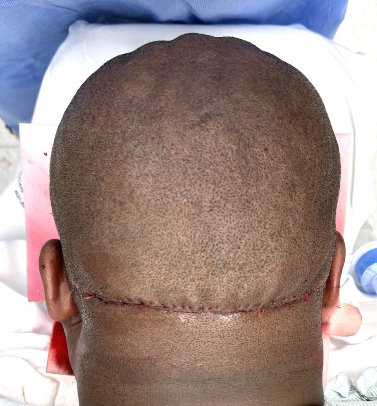 Plastic Surgery Case Study - Scalp Roll Excision with Nuchal Ridge ...