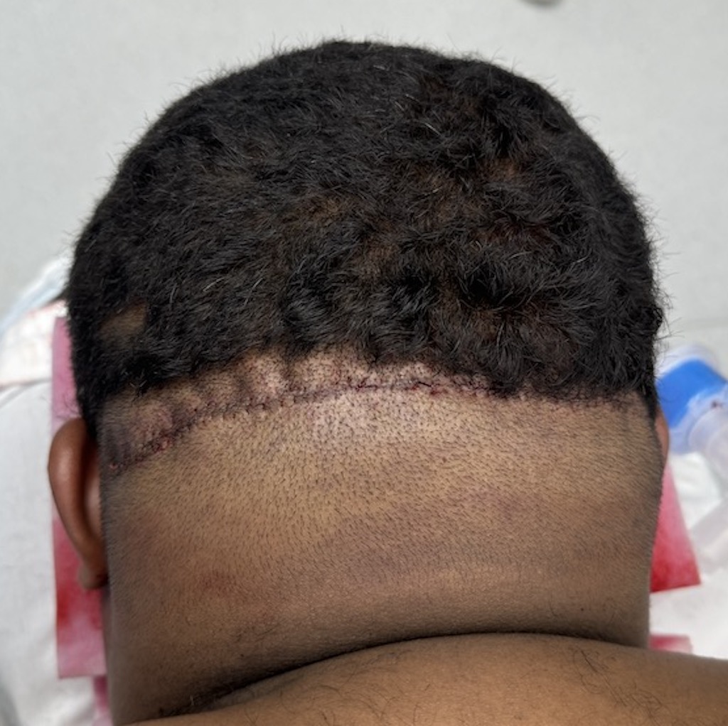 scalp roll excision closure back view 2 Dr Barry ERppley - Explore ...