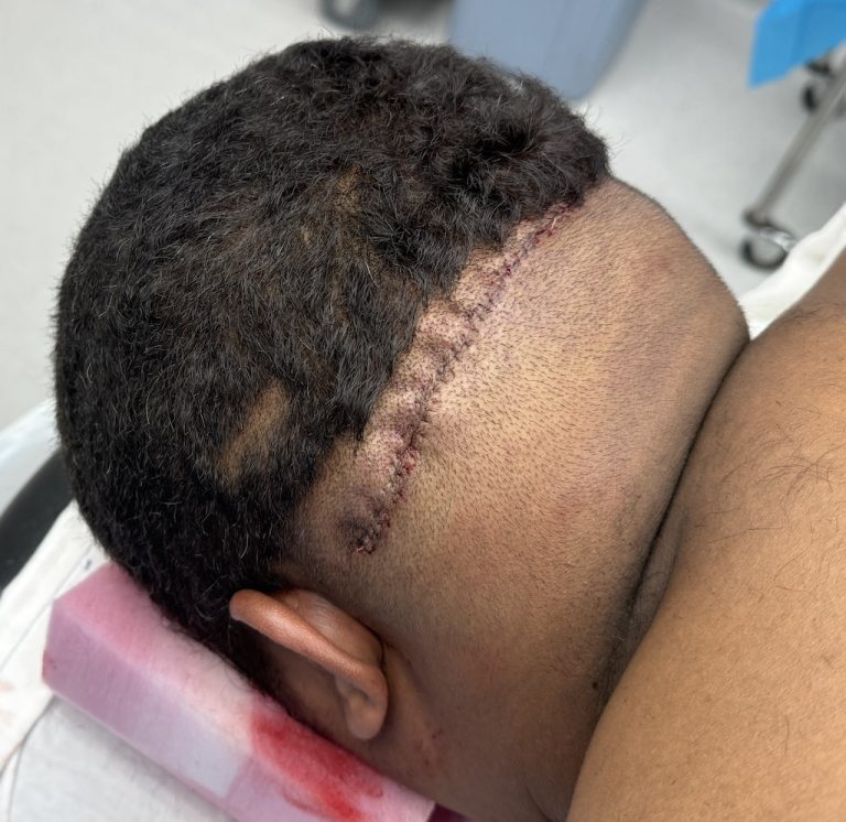 Plastic Surgery Case Study - Excision of Double Scalp Rolls after ...