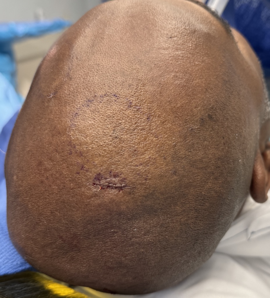 Small Skull Augmentations with Injections and Implant Sheeting ...