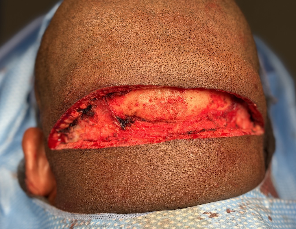 wide excisionm of scalp rolls with prominet nuchal ridge exposed Dr ...