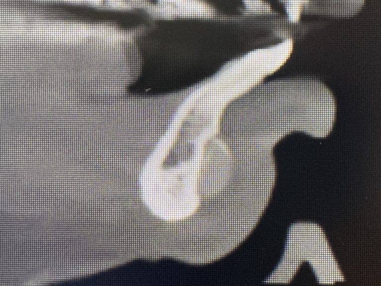 2D Ct scan of chin implant Dr Barry Eppley - Explore Plastic Surgery