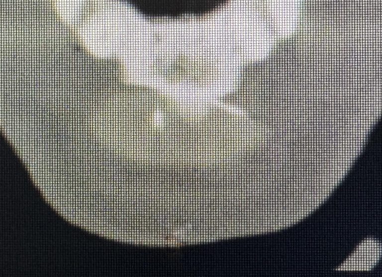 2D Ct scan of chin implant front view Dr Barry Eppley - Explore Plastic ...