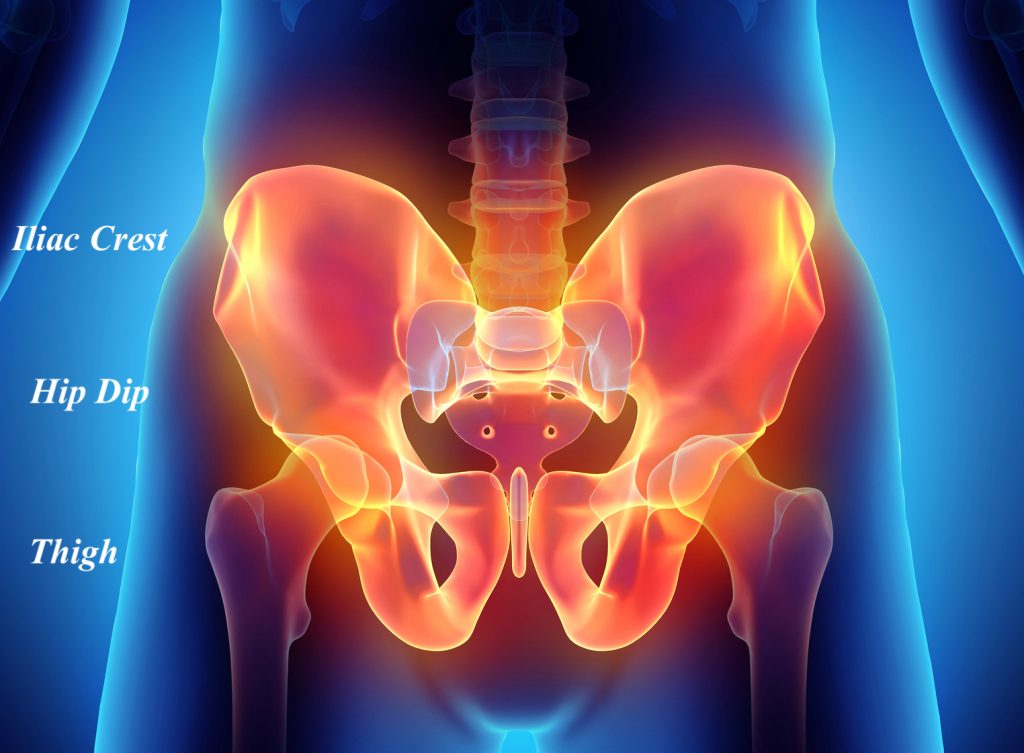 Pelvic Plasty - 4. The Sub Iliac Plate Hip Dip Implant - Explore ...