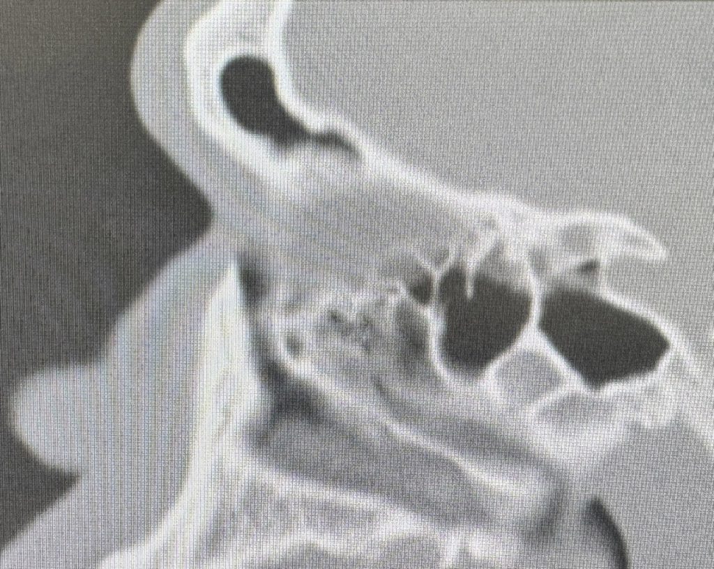 Plastic Surgery Case Study: Male Brow Bone and Forehead Reductions with ...