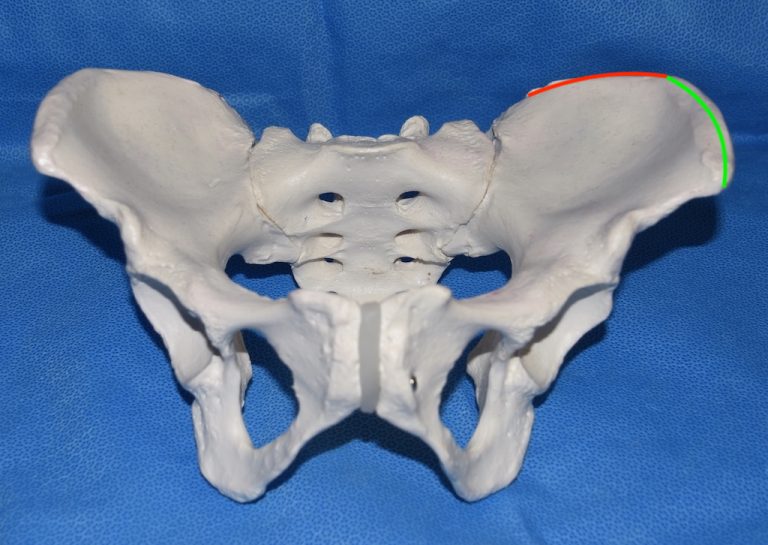 Pelvic Plasty - 1. The Anatomic Basis for Increasing Pelvic Bone Width ...