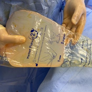 pectoral implants Archives - Explore Plastic Surgery