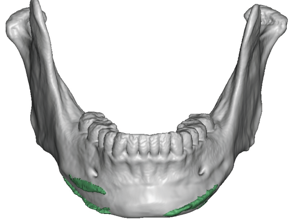 bone overgrowth on chin implant 3D CT scan front view Dr Barry Eppley ...