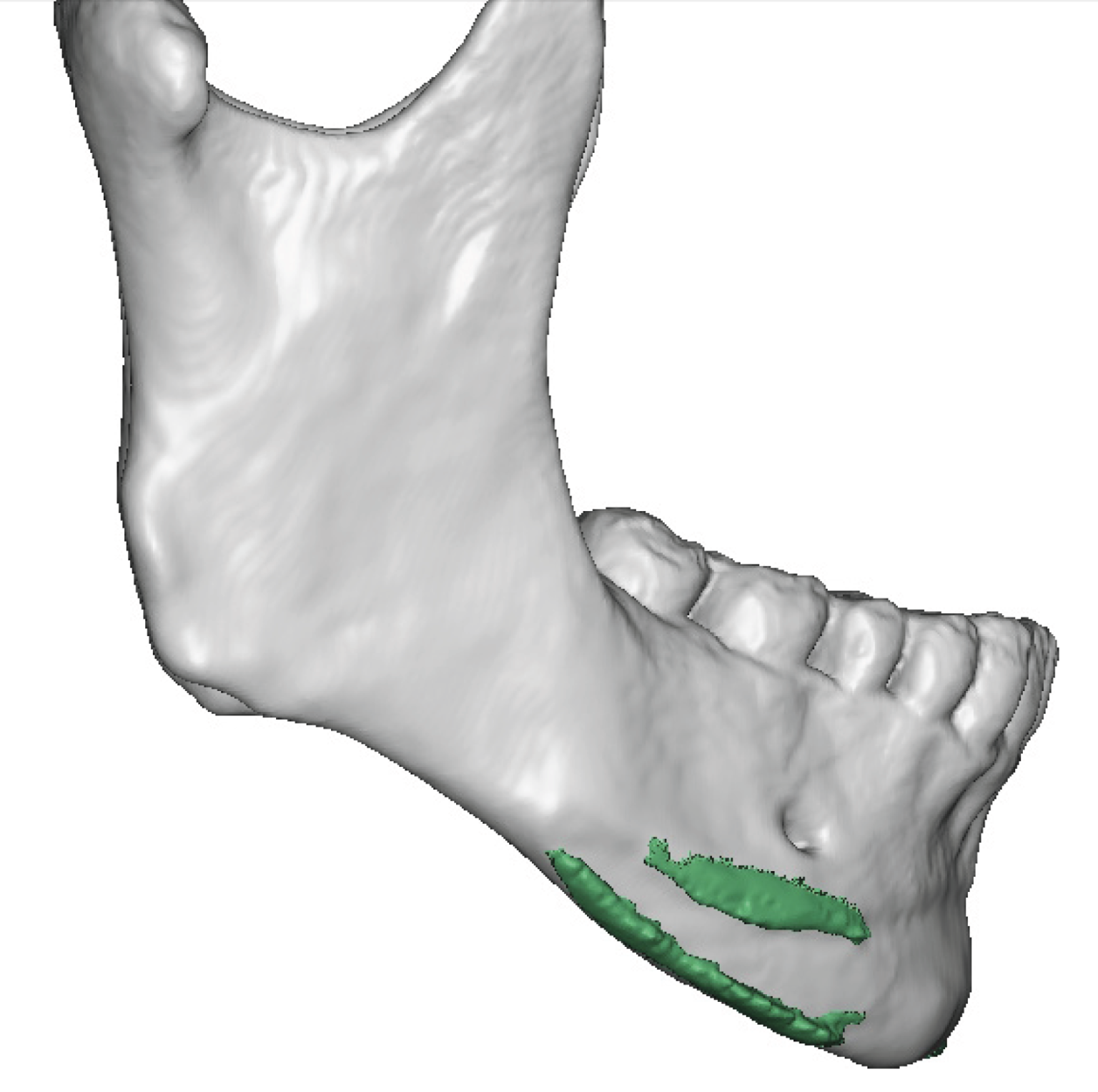 Plastic Surgery Case Study - Chin Implant Bony Overgrowth Removal with ...