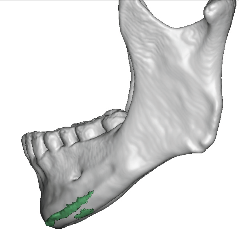 Plastic Surgery Case Study - Chin Implant Bony Overgrowth Removal with ...