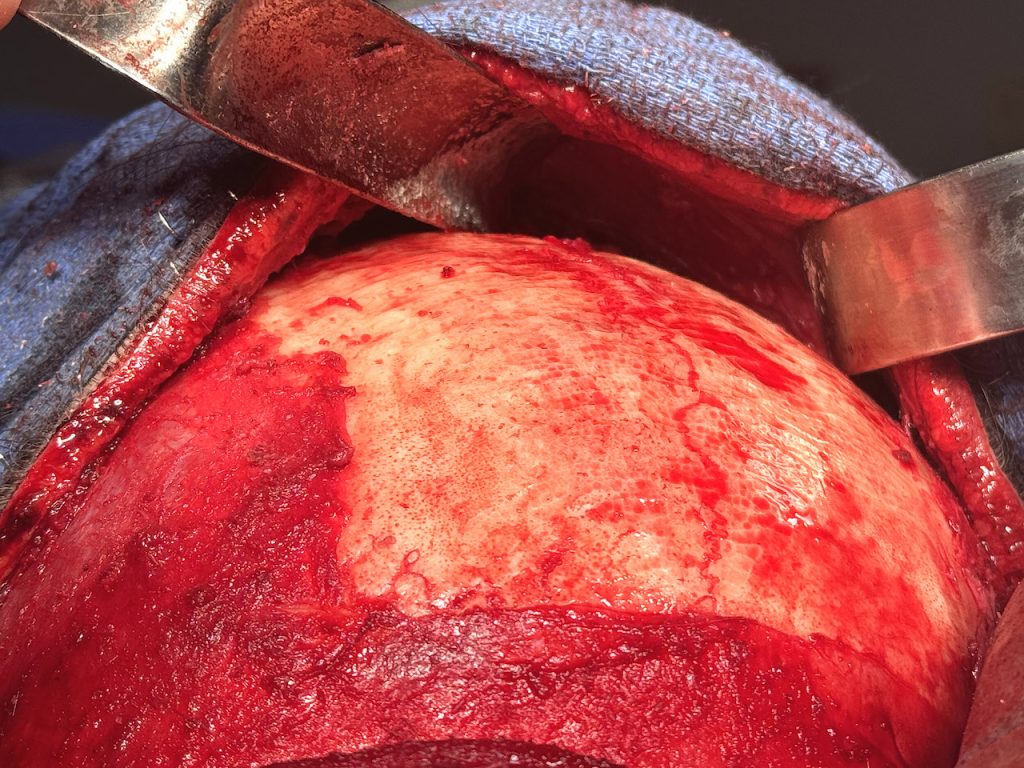 Plastic Surgery Case Study: Male Brow Bone and Forehead Reductions with ...