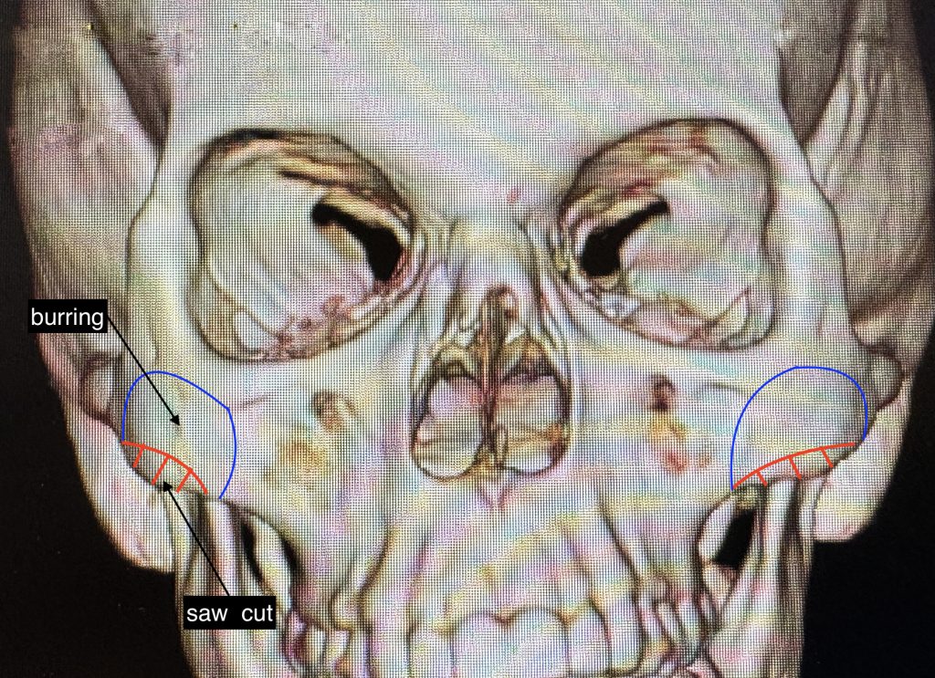 The Role of Shaving Techniques in Cheekbone Reductions - Explore ...