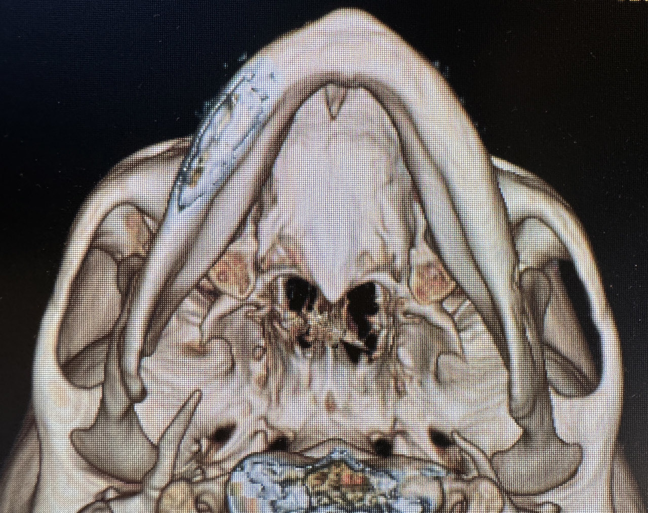 cheekbones 3D CT scan submental view Dr Barry Eppley - Explore Plastic ...