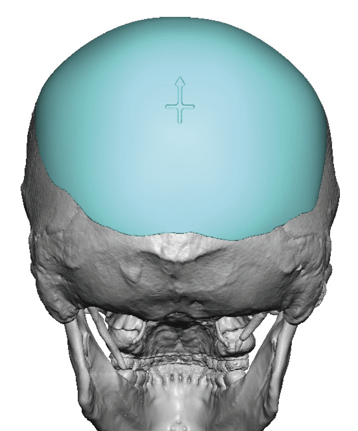 custom back of head skull implant with occipital knob reduction back ...