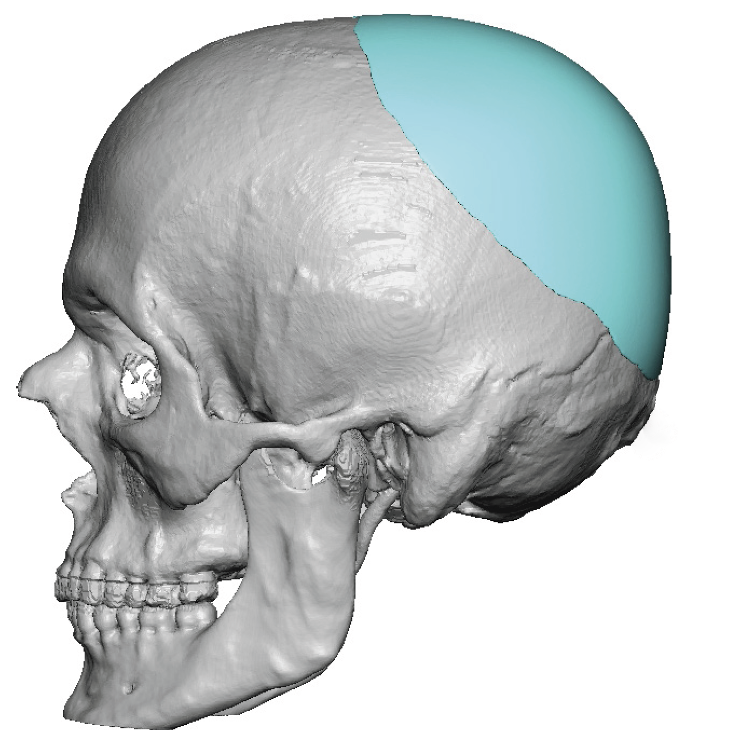 custom back of head skull implant with occipital knob reduction side ...