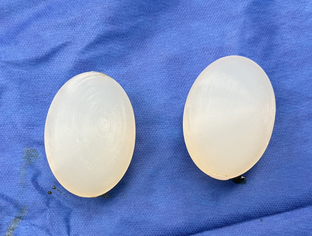 custom testicle implants intraop Dr Barry Eppley - Explore Plastic Surgery