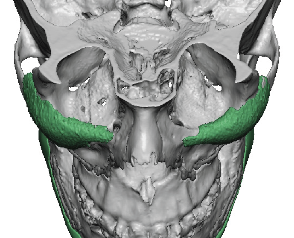 existing IOM implants 3D CT scan top view Dr Barry Eppley - Explore ...