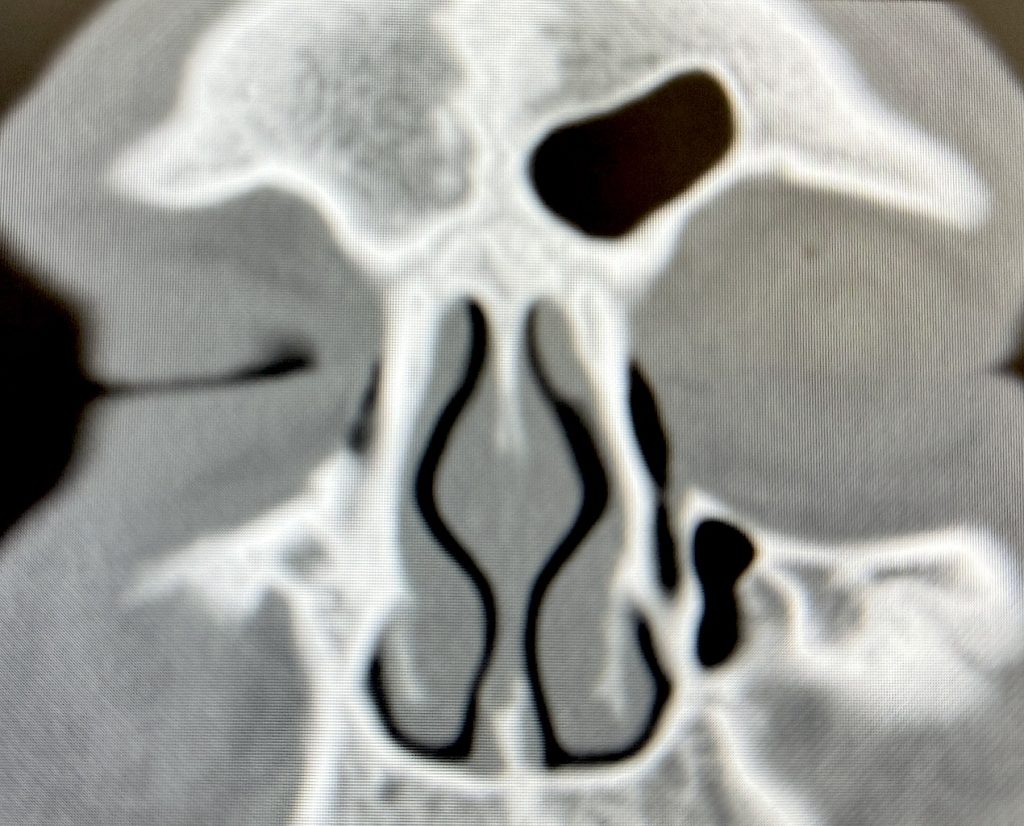 Plastic Surgery Case Study: Male Brow Bone and Forehead Reductions with ...