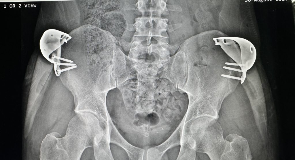 Pelvic Plasty - 4. The Sub Iliac Plate Hip Dip Implant - Explore ...