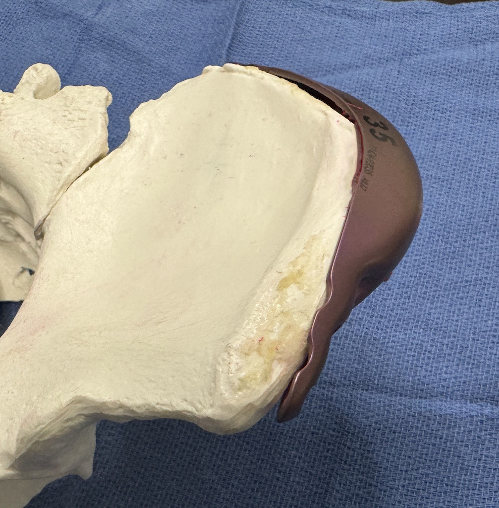 iliac plate position on the iliac crest Dr Barry Eppley - Explore ...