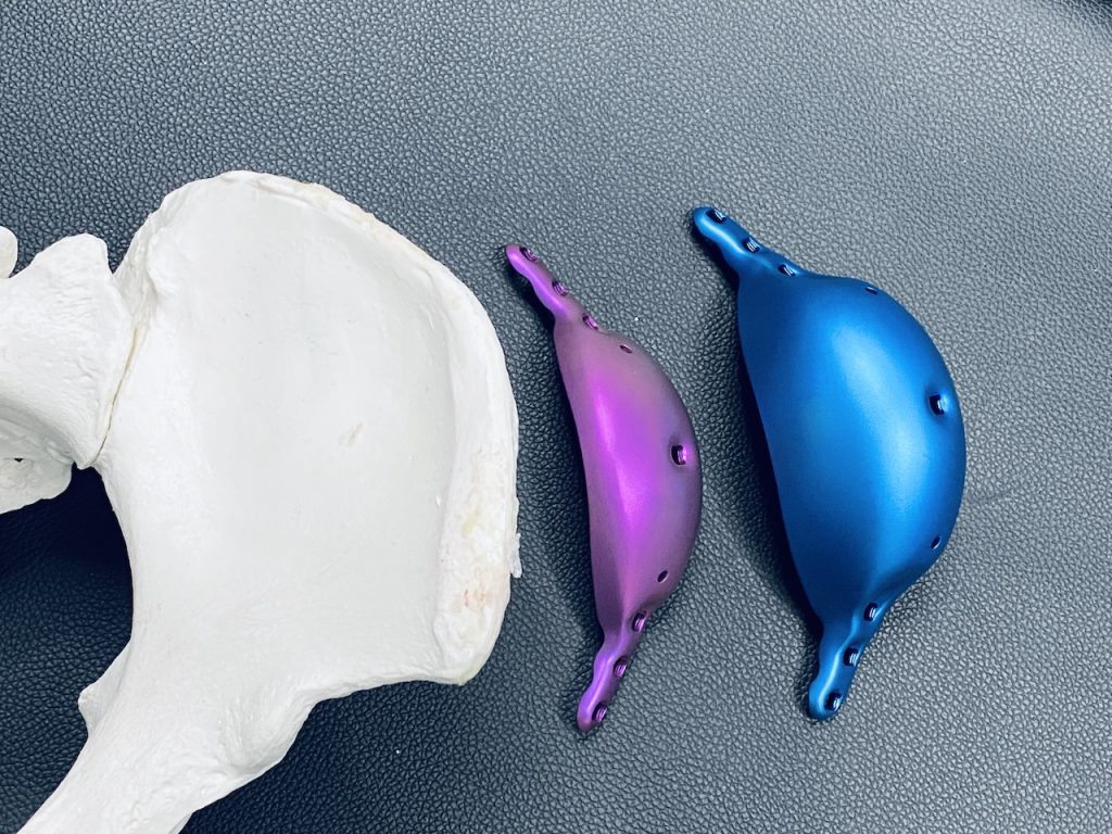 Pelvic Plasty - 2. The Iliac Plate - Explore Plastic Surgery