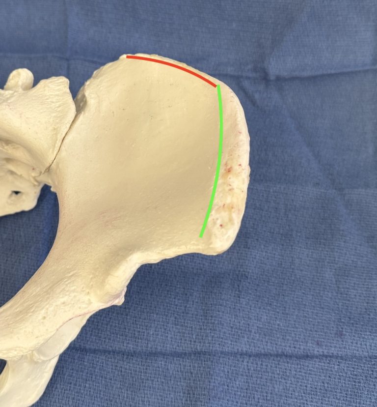 Pelvic Plasty - 3. Surgical Placement of the Iliac Plates - Explore ...