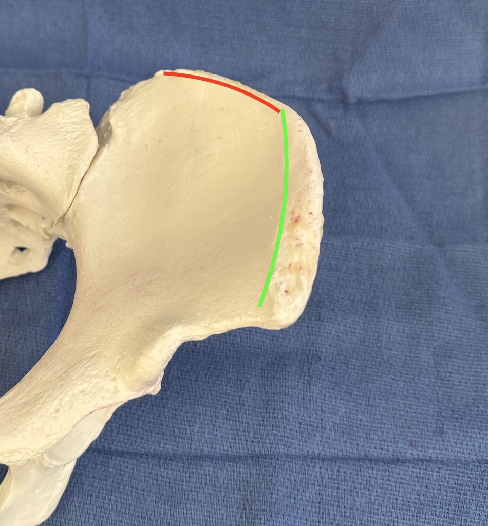 Pelvic Plasty - 3. Surgical Placement of the Iliac Plates - Explore ...