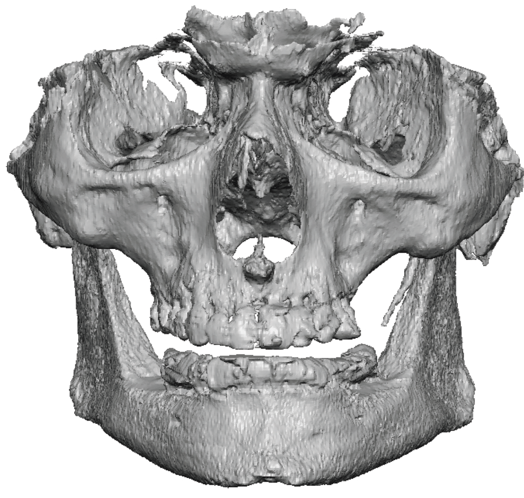 jaw with cleft 3D CT scan front view Dr Barry Eppley - Explore Plastic ...