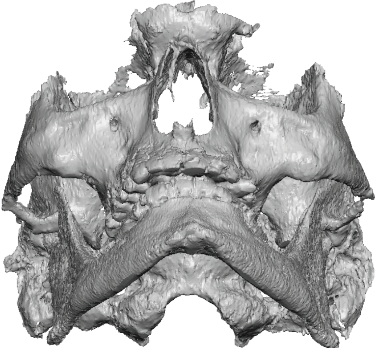 jaw with cleft 3D CT scan submental view Dr Barry Eppley - Explore ...