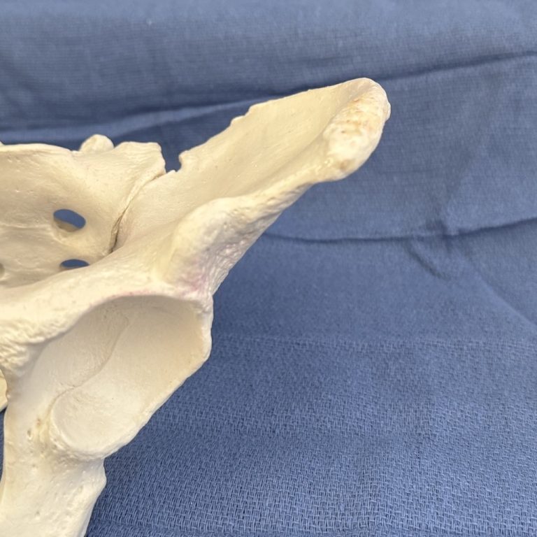 Pelvic Plasty - 3. Surgical Placement of the Iliac Plates - Explore ...