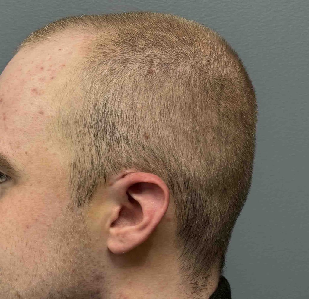 Plastic Surgery Case Study - Back and Side of Head Combined Skull ...