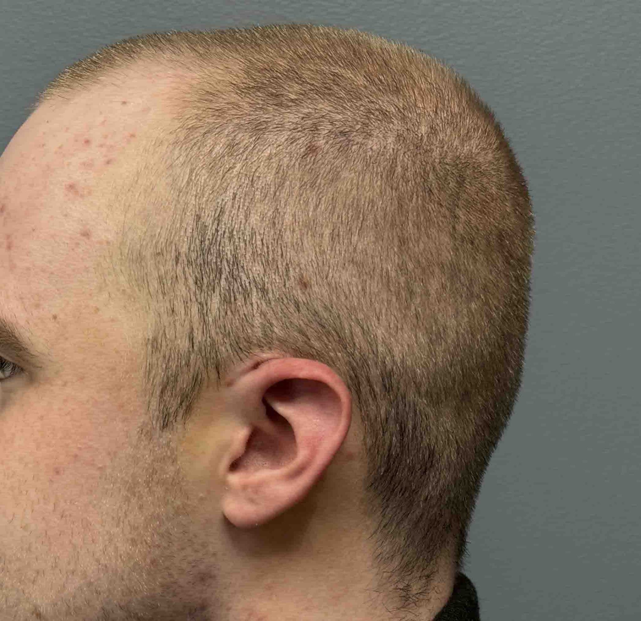 Plastic Surgery Case Study - Back and Side of Head Combined Skull ...
