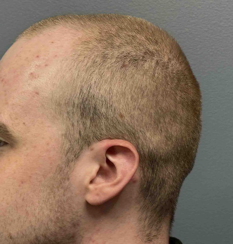 Plastic Surgery Case Study - Back and Side of Head Combined Skull ...