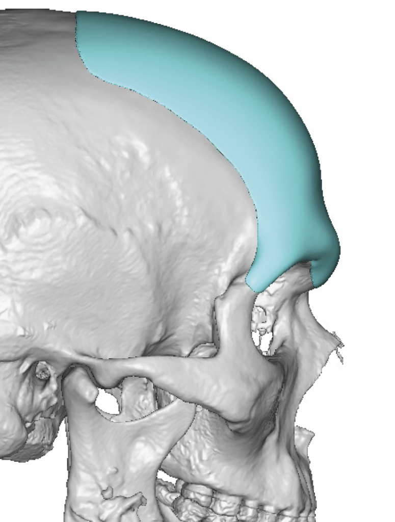 Plastic Surgery Case Study - Male Custom Forehead-Brow Bone Implant ...