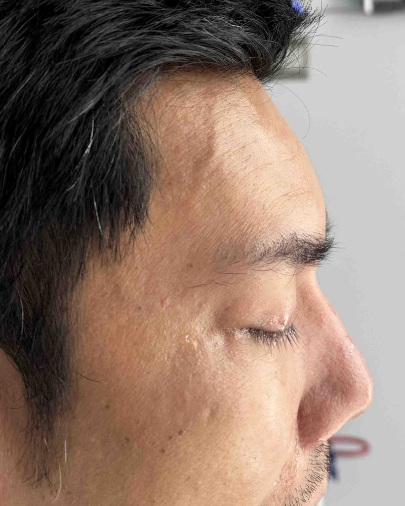 Plastic Surgery Case Study - Male Custom Forehead-Brow Bone Implant ...