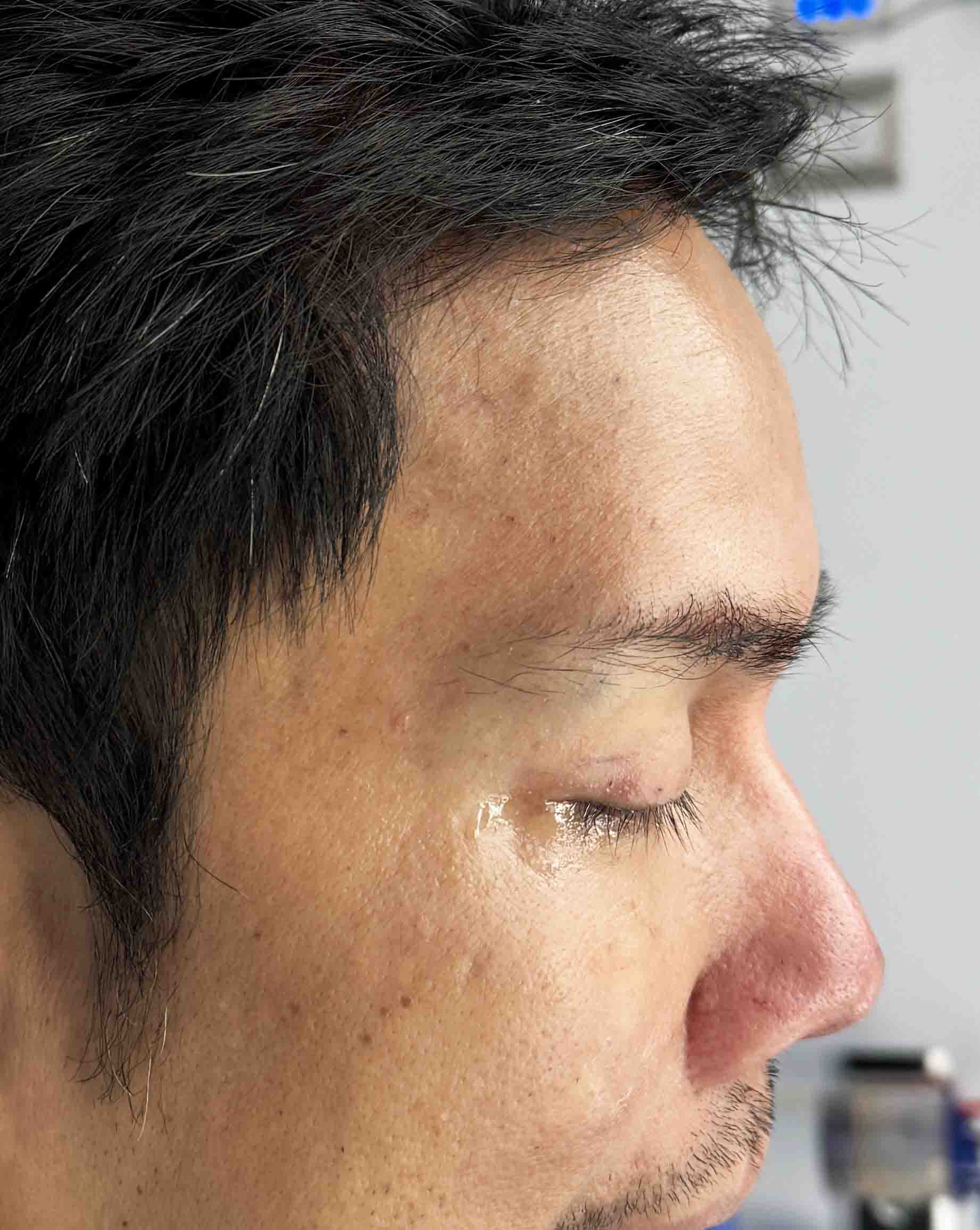 male custom forehead brow bone implant intraop side 2 Dr Barry Eppley ...