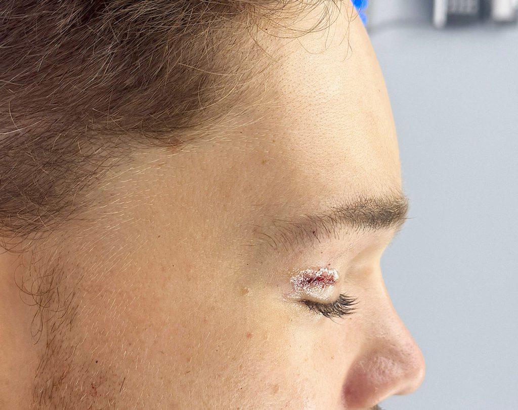 Plastic Surgery Case Study: Male Brow Bone and Forehead Reductions with ...